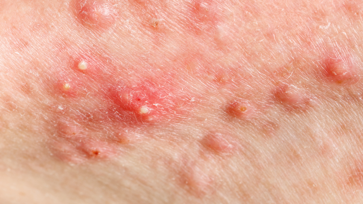 Azelaic Acid For Acne | Will It Help? - Millionaire Beauty